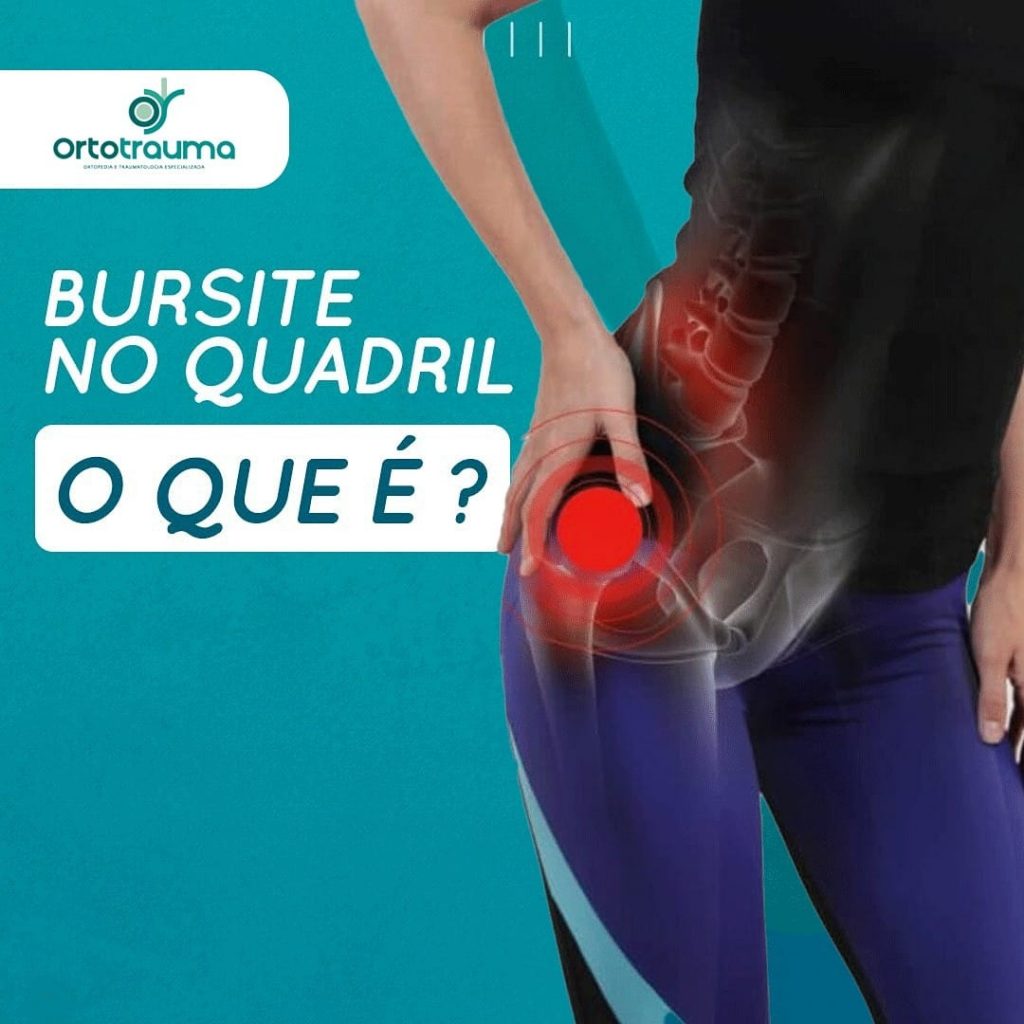 Bursite no quadril, o que é? - Ortotrauma