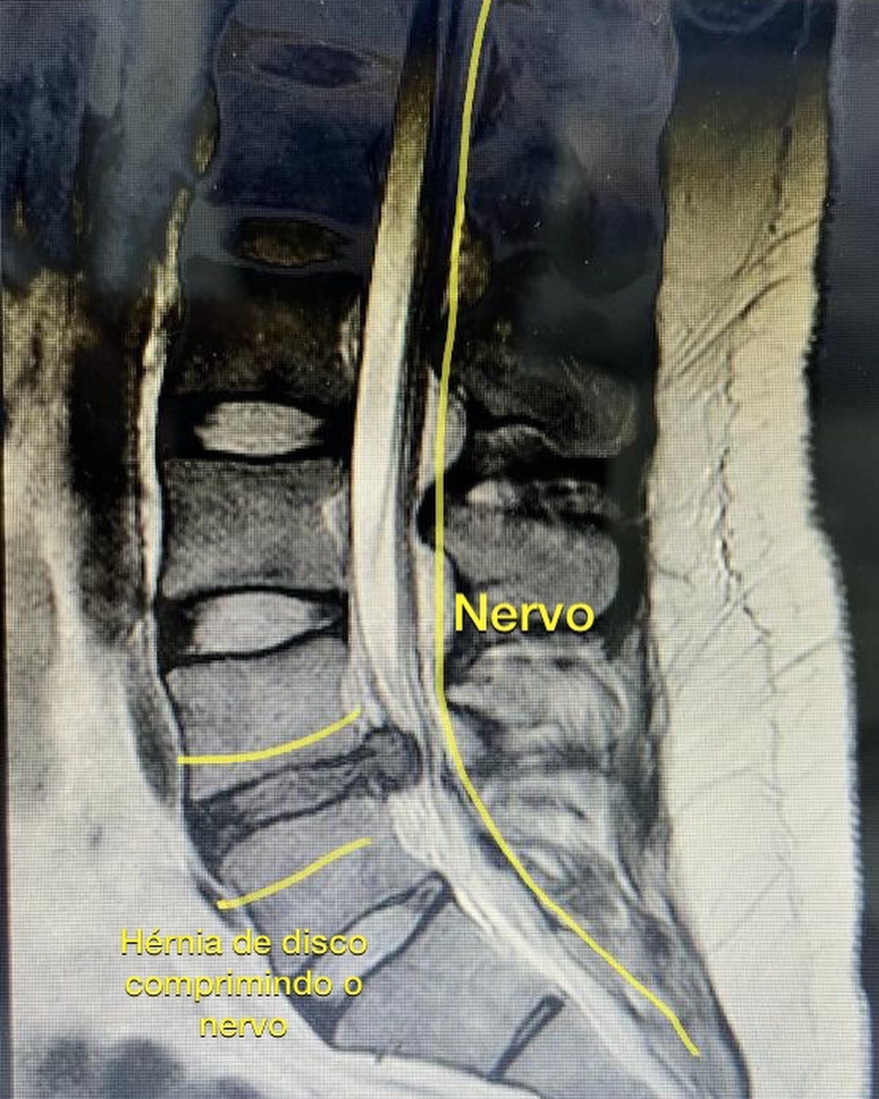 Hérnia de disco - Ortotrauma
